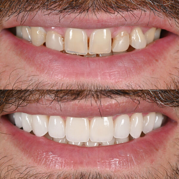 Before and After Photos - Apa Aesthetic